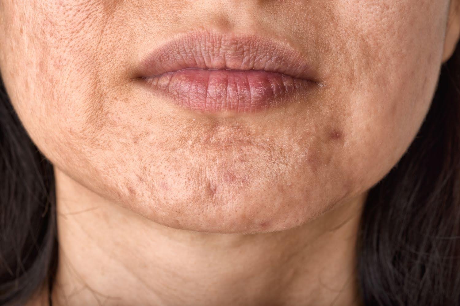 Erdbeerkinn behandeln: Welche Alternativen zu Botox gibt es? ⋆ ...